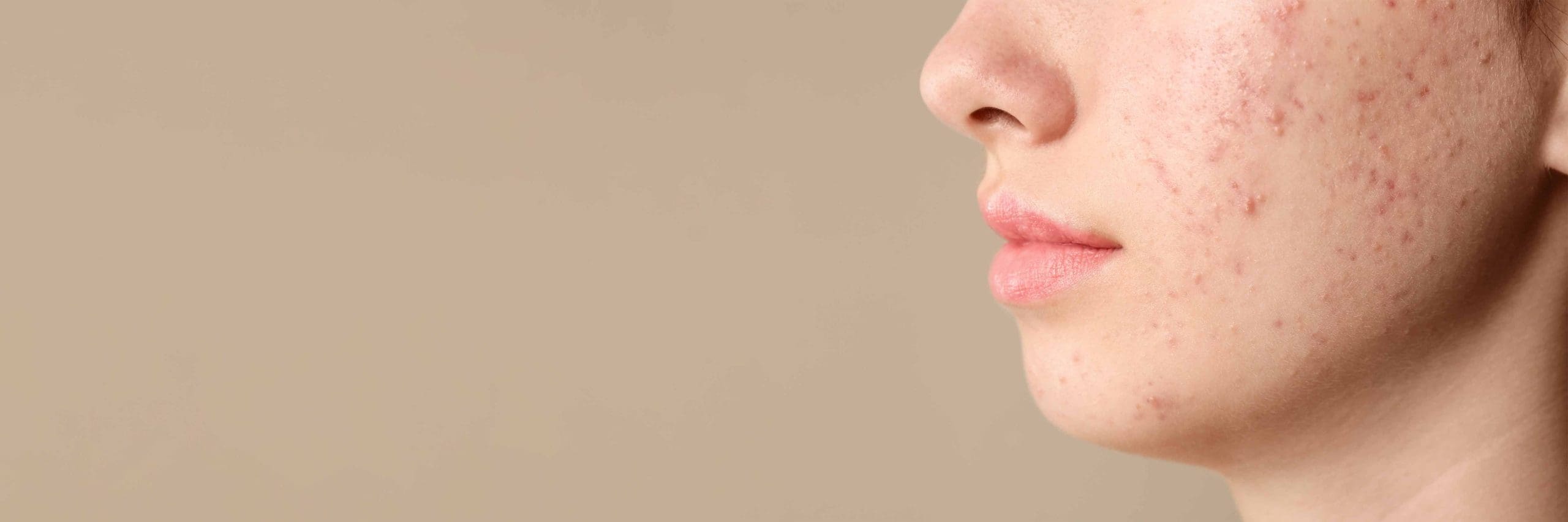 Acne Treatment Perth | Book Laser Therapy for Scars & More